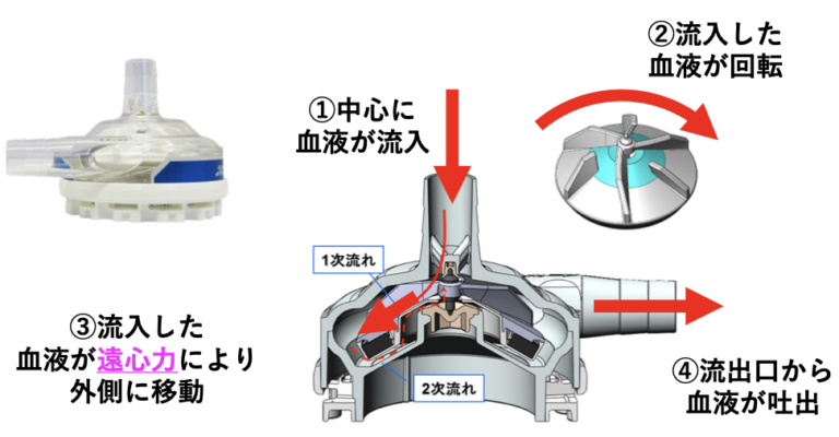 Ecmoextracorporeal Membranous Oxygenation)体外式膜型人工肺 Me