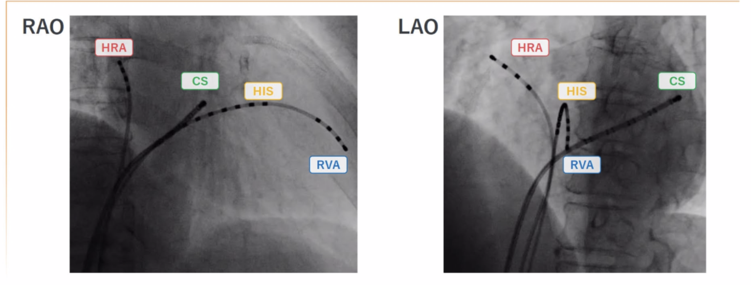 RFCA カテーテルアブレーション | me