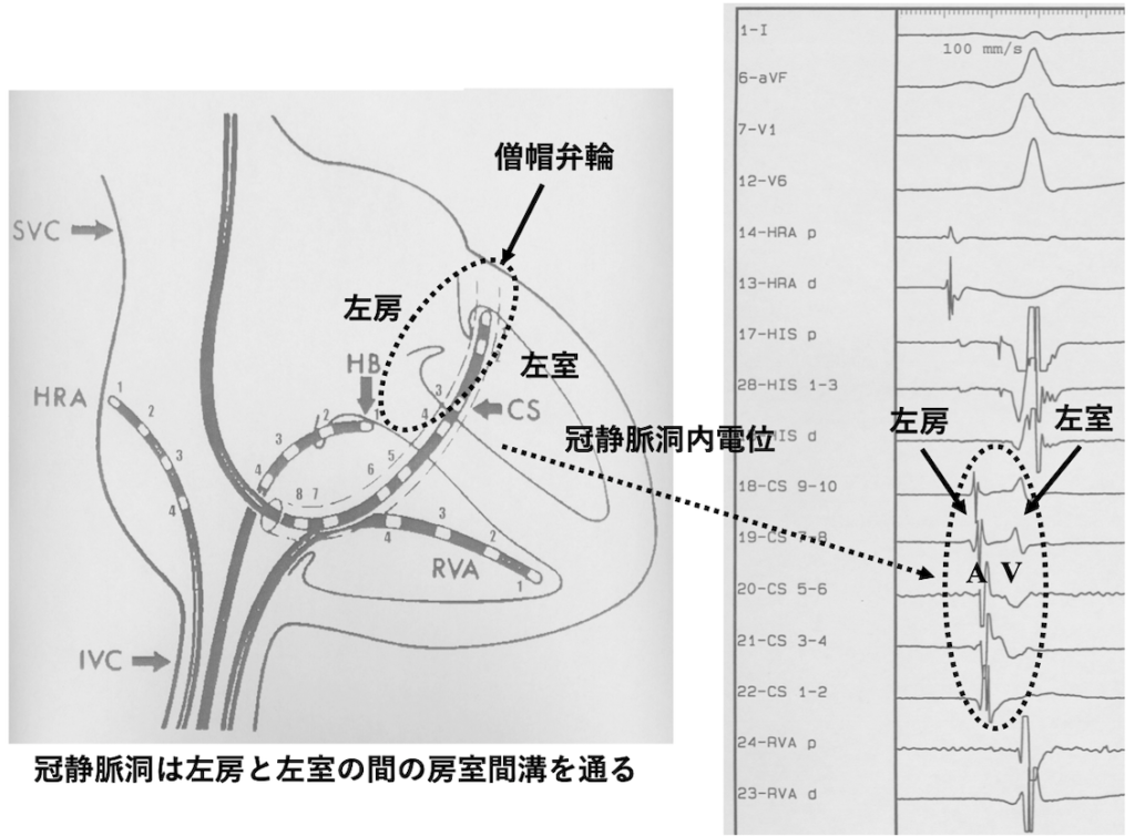 RFCA カテーテルアブレーション | me