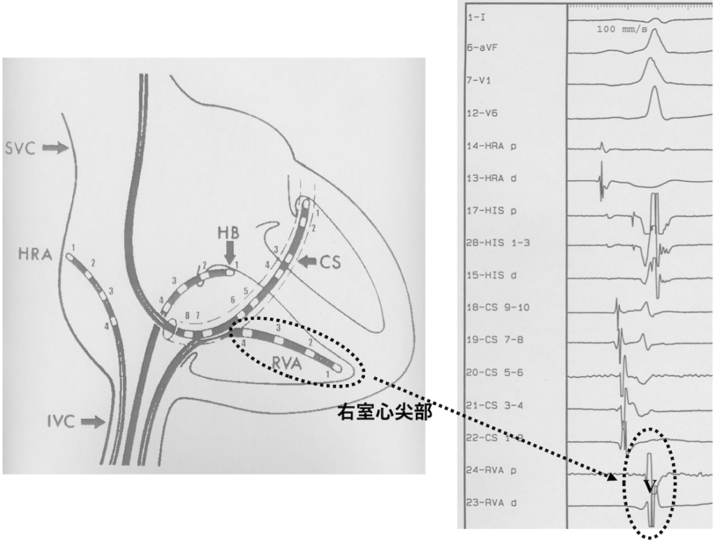 RFCA カテーテルアブレーション | me