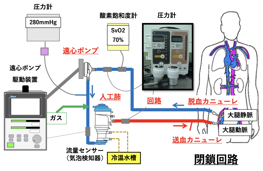 ECMO(Extracorporeal Membranous Oxygenation）体外式膜型人工肺 | me