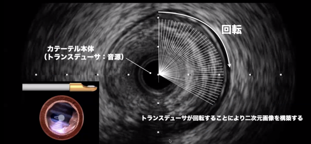 IVUS:Intravascular Ultrasound(血管内超音波) | me