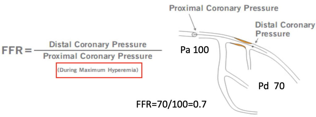 FFR/iFRについて | me