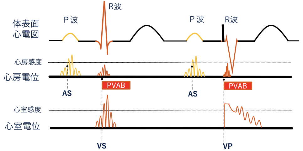 植込み型心臓デバイスのペースメーカ | me