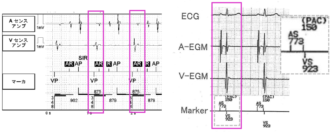 植込み型心臓デバイスのペースメーカ | me