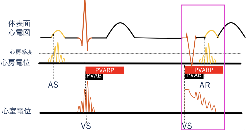 植込み型心臓デバイスのペースメーカ | me