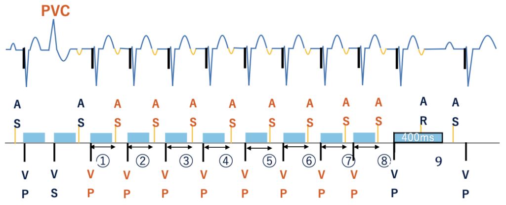 植込み型心臓デバイスのペースメーカ | me