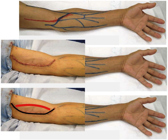 透析シャントにおける動脈表在化 | me