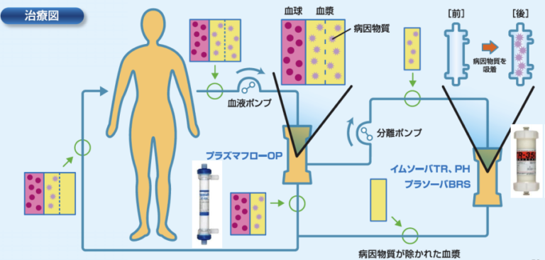 血漿吸着療法PA：Plasma Adsorption | me