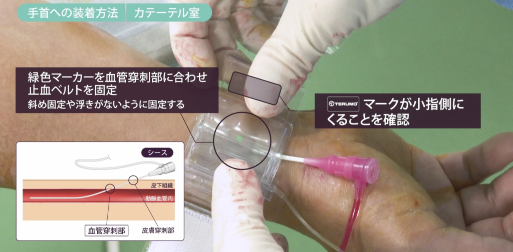 止血デバイスのTRバンド | me