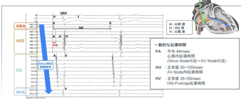 RFCA カテーテルアブレーション | me