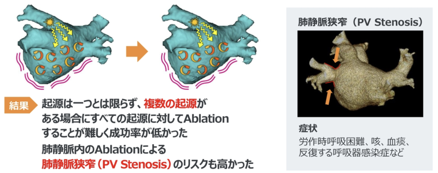 心房細動アブレーションの変遷 | me